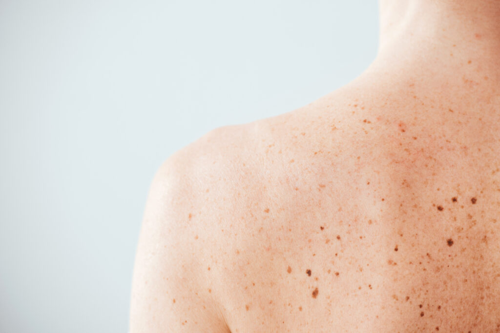 The ABCDEs of Melanoma: Early Detection